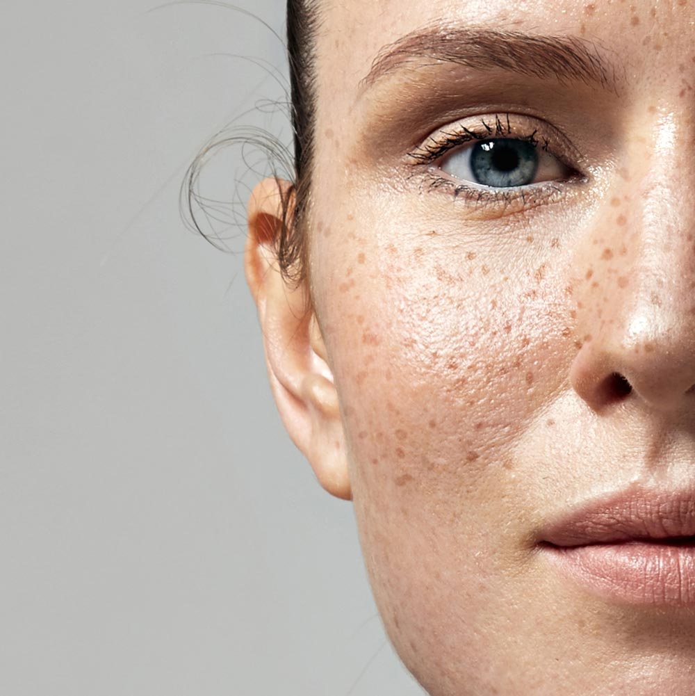 Pigmentação / Manchas - Evelina Ruas Dermatologia - centro de ...